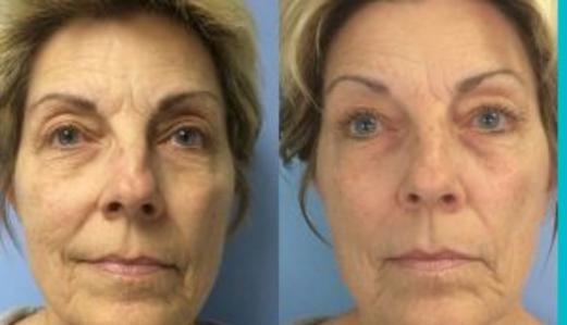 A Way of Life Acupuncture - LED Light Therapy, Celluma