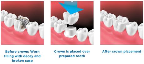 Affordable Jacket Crowns in Metro Manila - DentaGem Dental Clinics