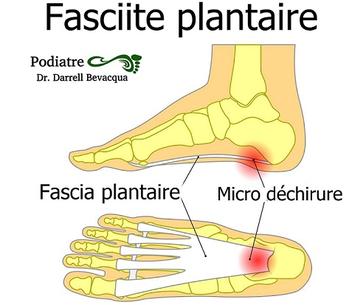 Douleur Au Talon, Épine De Lenoir, Fasciite Plantaire, Pied Plat et ...