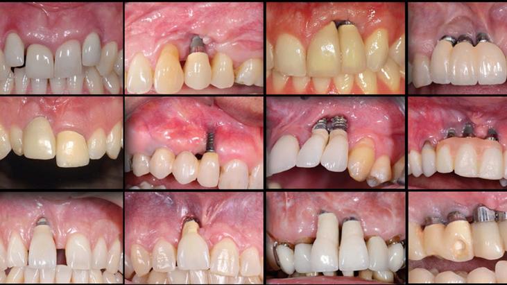 Dangers Of Improper Dental Implant Position