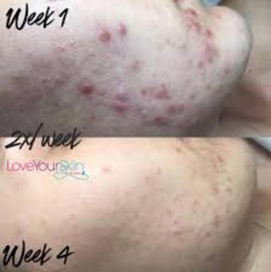 A Way of Life Acupuncture - LED Light Therapy, Celluma