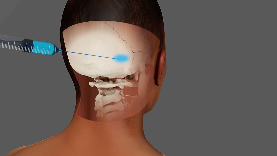 Occipital Nerve Block Occipital Nerve Block | Pain Relief In The
