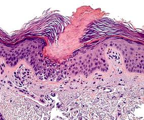 TransDermSolutions Removes Plantar IPK & Warts Nonsurgically