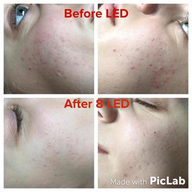 A Way of Life Acupuncture - LED Light Therapy, Celluma