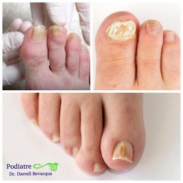 Mycose des ongles (Onychomycose) Votre Solution