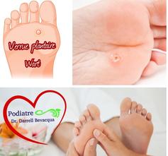 Orthèse plantaire, Ongle incarné, Verrues, Soins des pieds