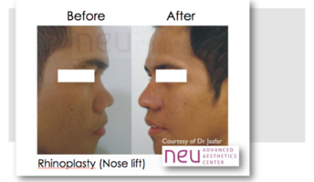 Rhinoplasty Philippines